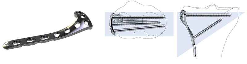 Titanium Locking Compression Plate LCP,Canwell_specification/price ...